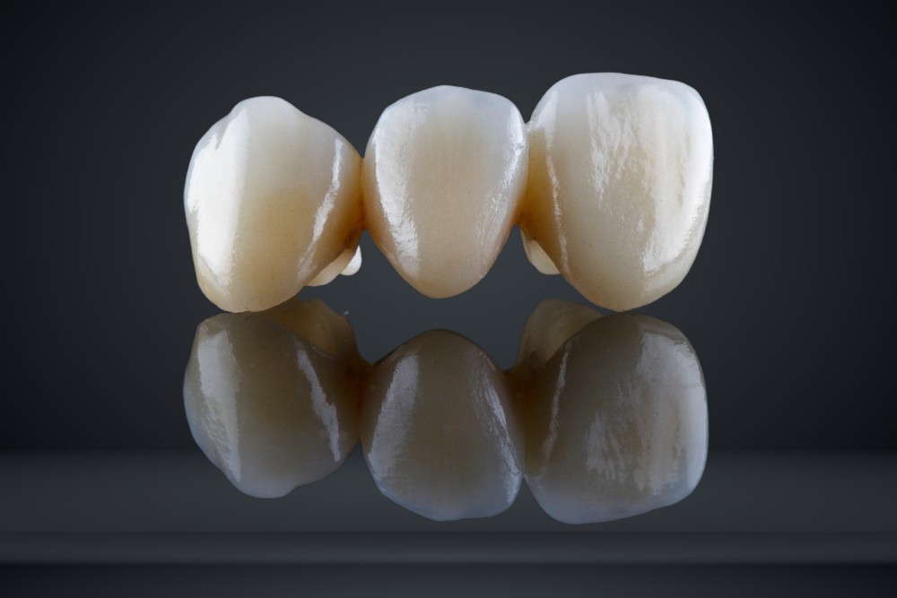 Layered Ceramics - Precision Arts Dental Studio - Pinole & San Leandro, CA